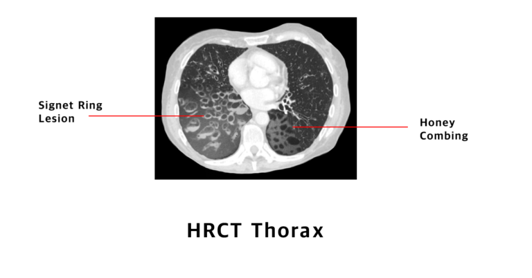 Causes, Symptoms, Diagnosis and treatment of bronchiectasis | Holistic ...