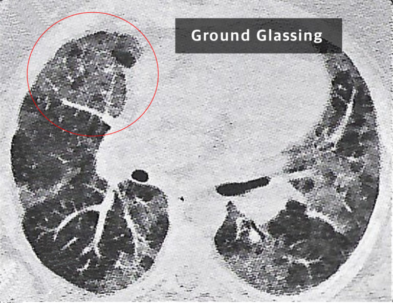 Pulmonary Interstitium and Interstitial lung disease | Holistic Doctor ...